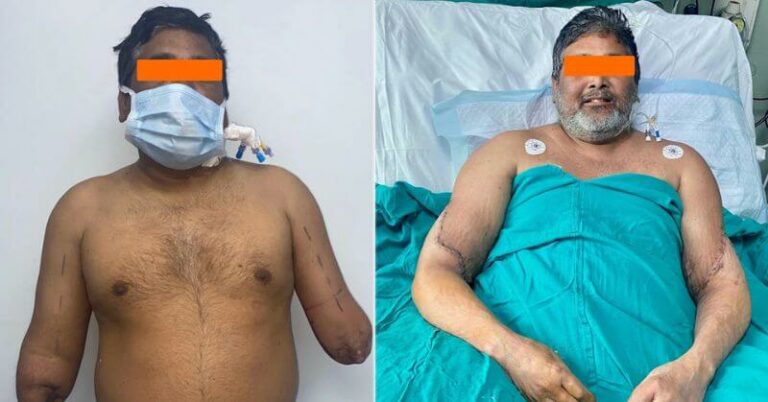 Delhi's First Ever Bilateral Hand Transplant Helps Painter Getting New ...