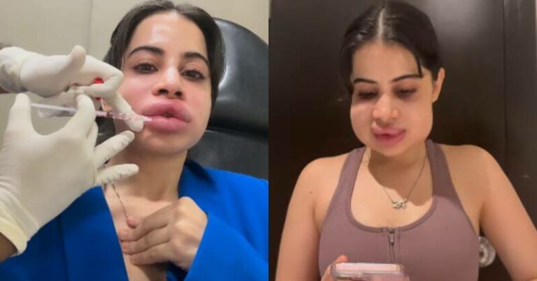 Urfi Javed Gets Real On Cosmetic Procedures, Dissolves Lip Fillers ...