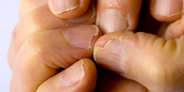 20 Symptoms Of HIV, Consult Your Doctor If You Feel These