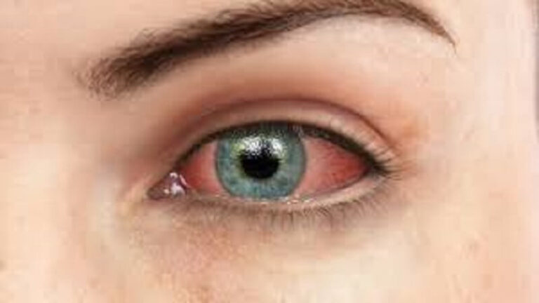What Causes Pink Eye And How Can You Avoid It?